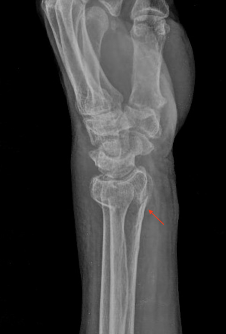 Fracture de Pouteau Colles - NPEM