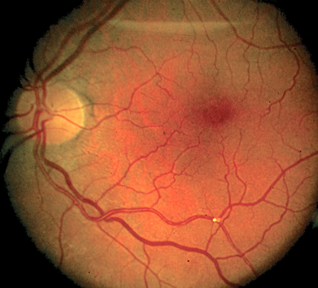 Plaque d’hollenhorst - NPEM