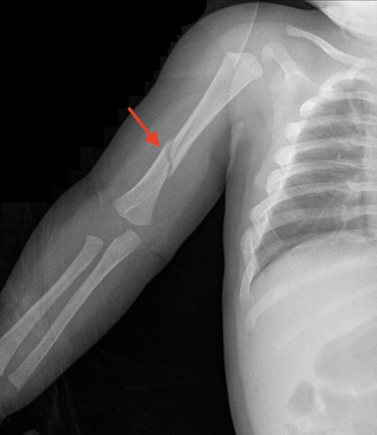 Syndrome de Silvermann - NPEM